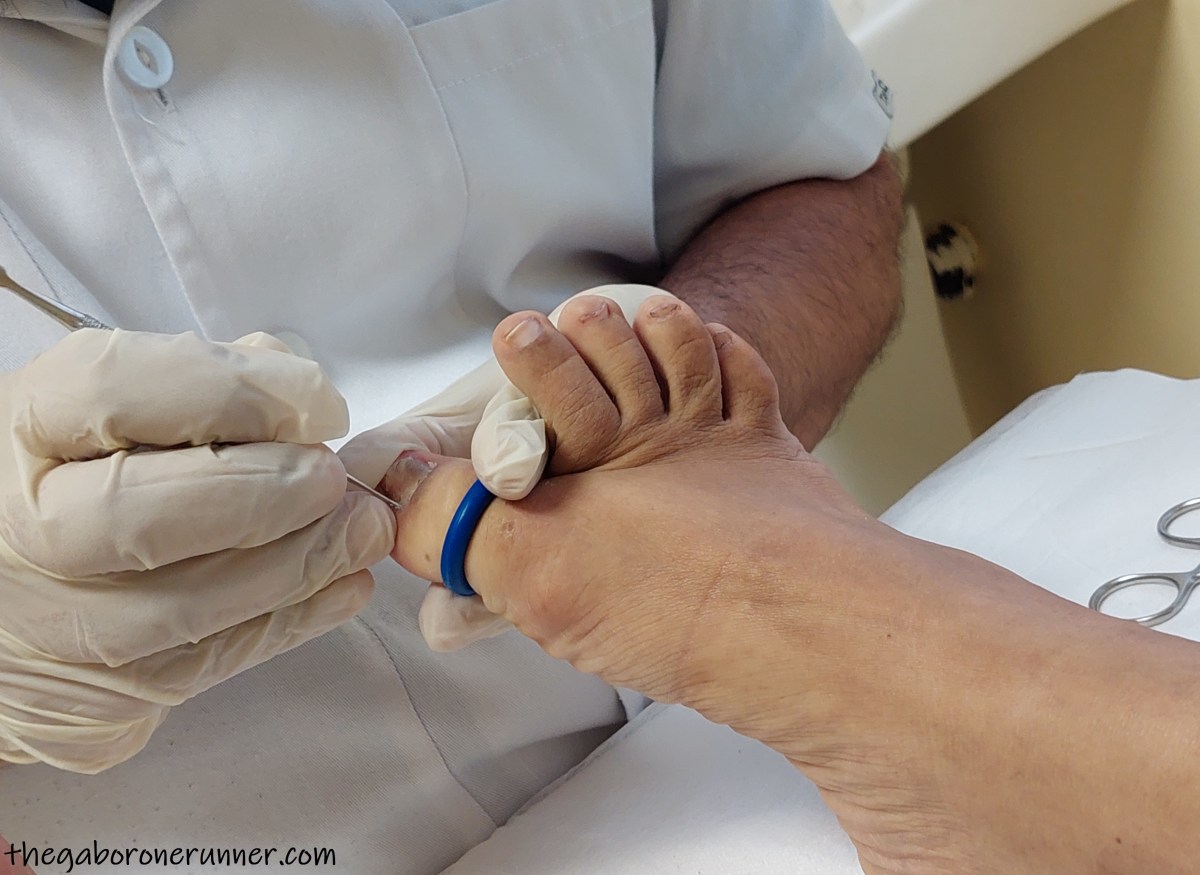 Why My Toenails Were Removed – The Gaborone Runner