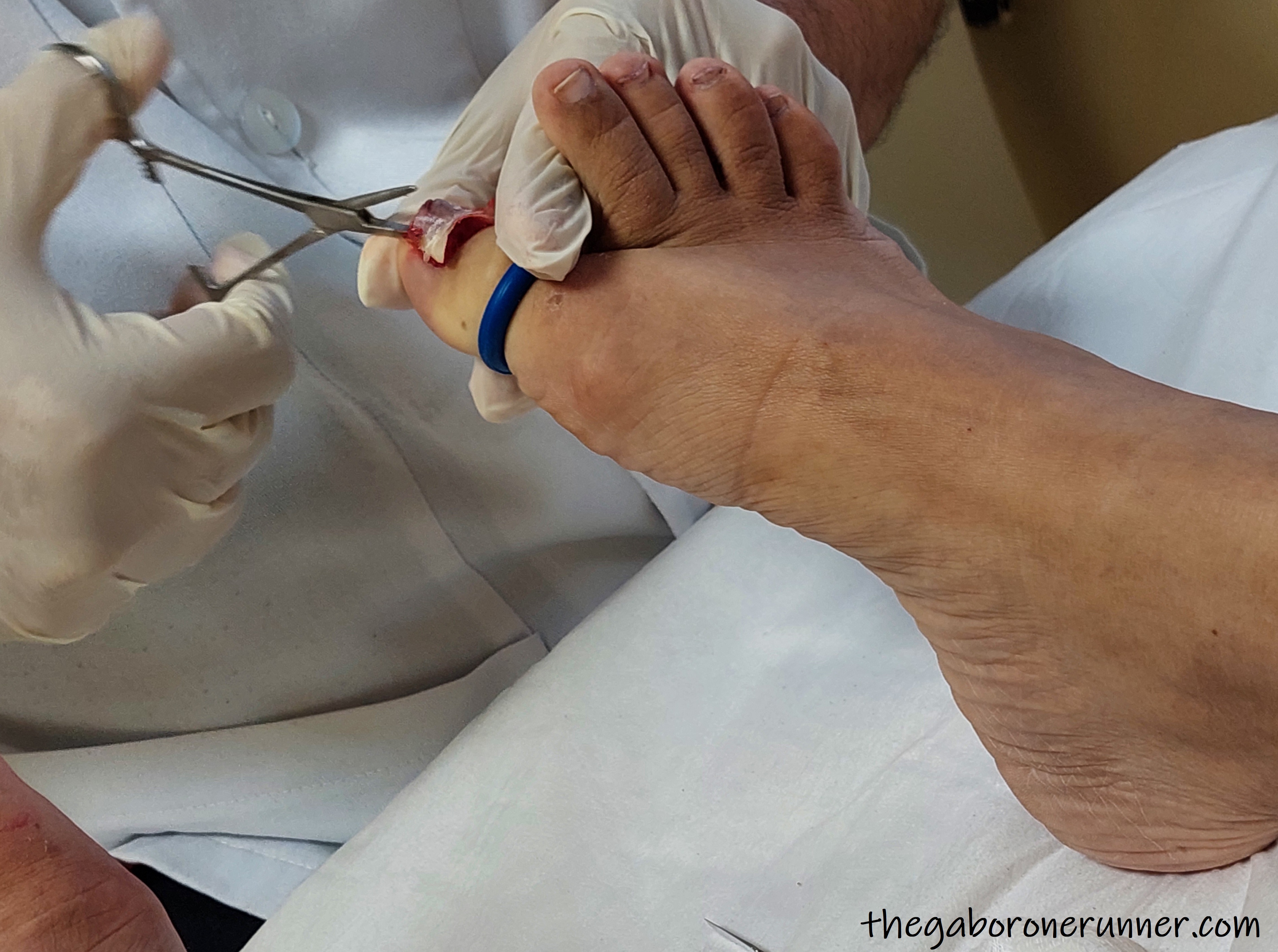 Why My Toenails Were Removed – The Gaborone Runner
